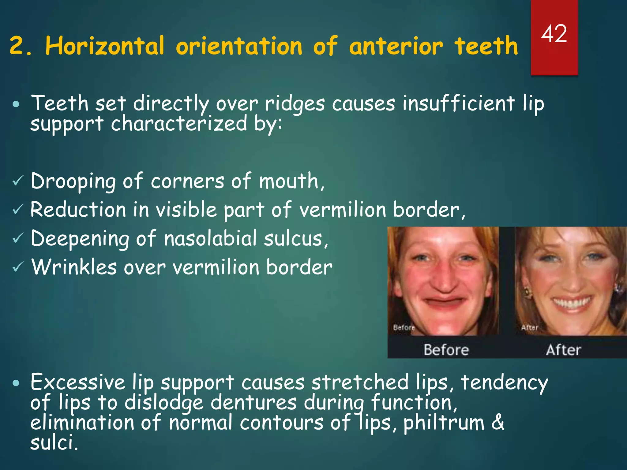 Try in of complete dentures | PPTX