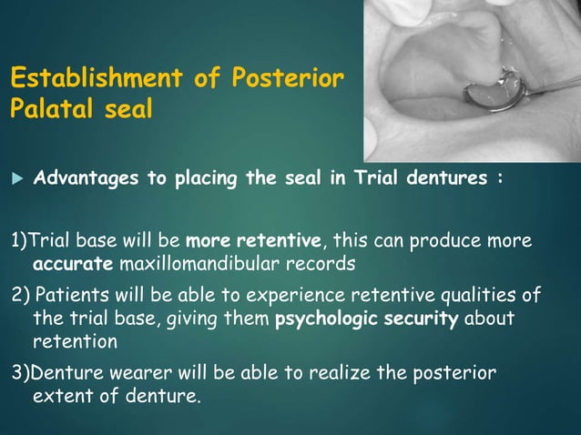 Try in of complete dentures | PPTX