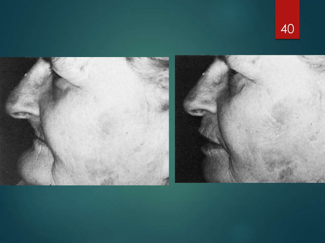 Try in of complete dentures | PPTX