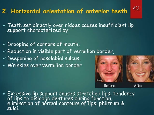 Try in of complete dentures | PPTX