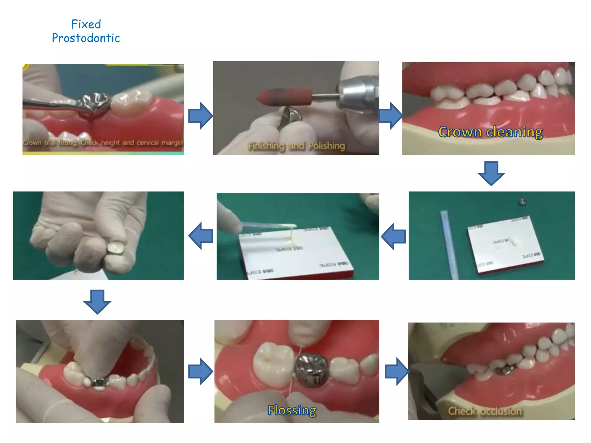 Try in and cementation of crown | PPTX