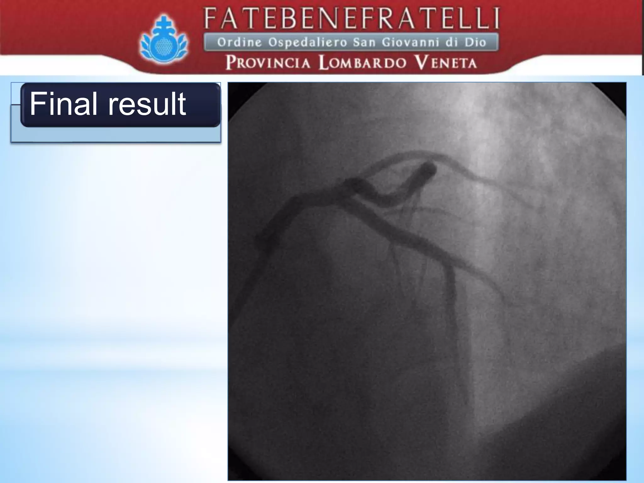Case based tutorial on bifurcation dedicated stent Tryton placement | PPT