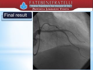 Case based tutorial on bifurcation dedicated stent Tryton placement | PPT