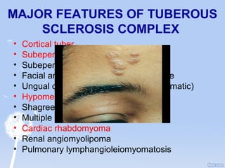 tuberus sclerosis | PPT