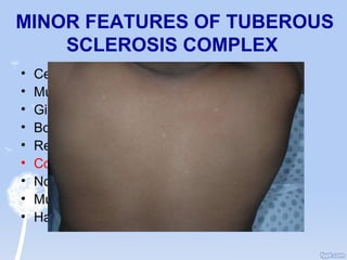 tuberus sclerosis | PPT