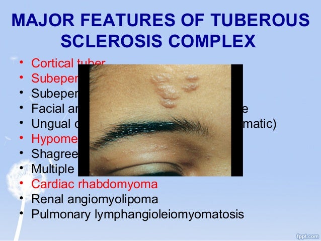 tuberus sclerosis