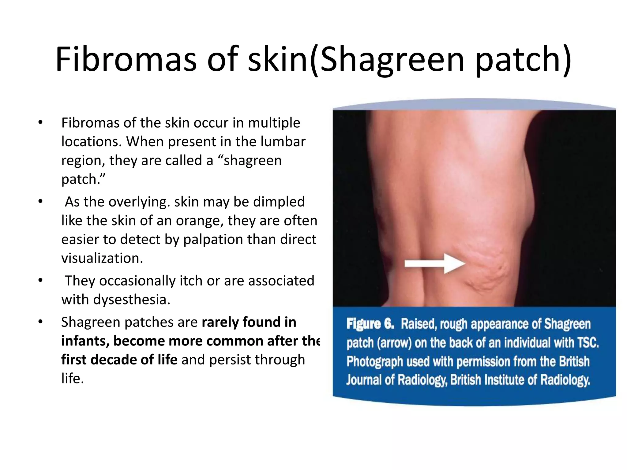 Tuberous sclerosis | PPTX