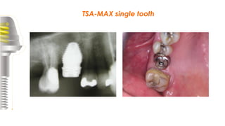 Tsa biomechanical abutment | PPT