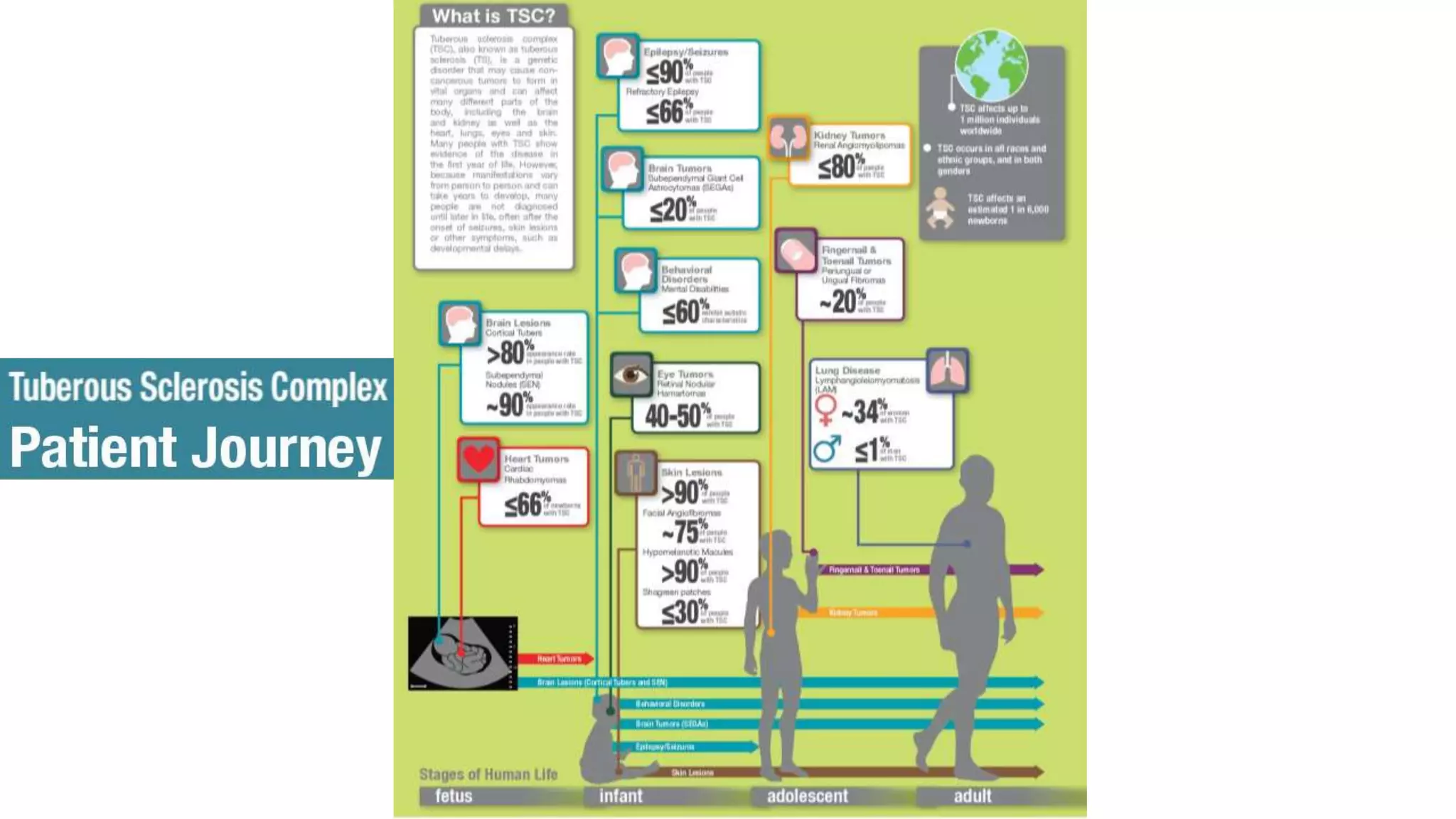 TUBEROUS SCLEROSIS COMPLEX (TSC) | PPTX