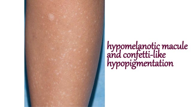 TUBEROUS SCLEROSIS COMPLEX (TSC)