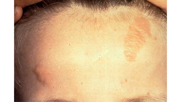 TUBEROUS SCLEROSIS COMPLEX (TSC)