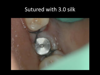 OCO Biomedical TSI Case | PPTX