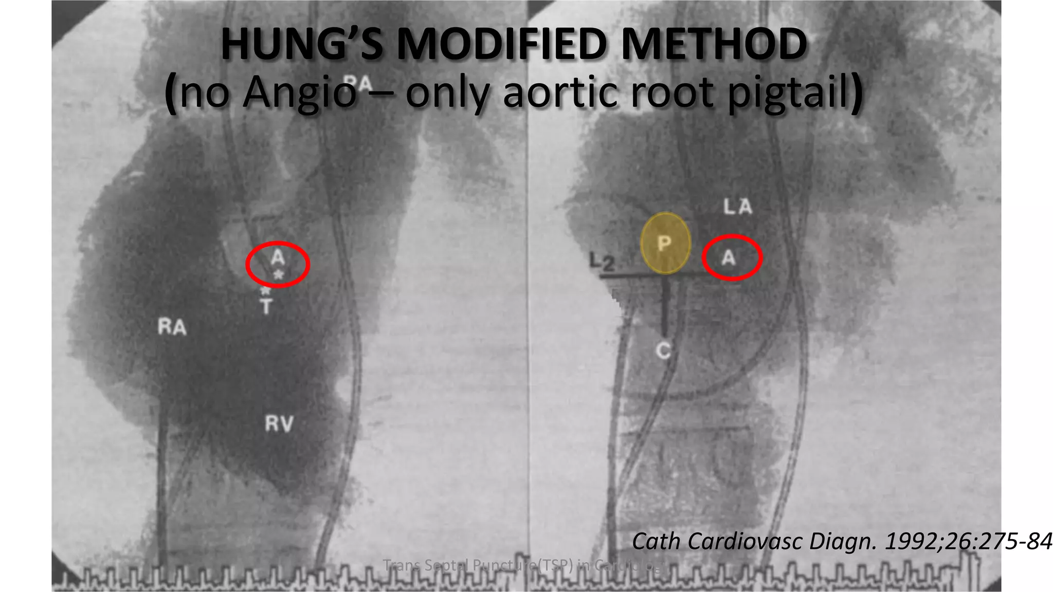 Trans septal Puncture in Cardiology | PPTX