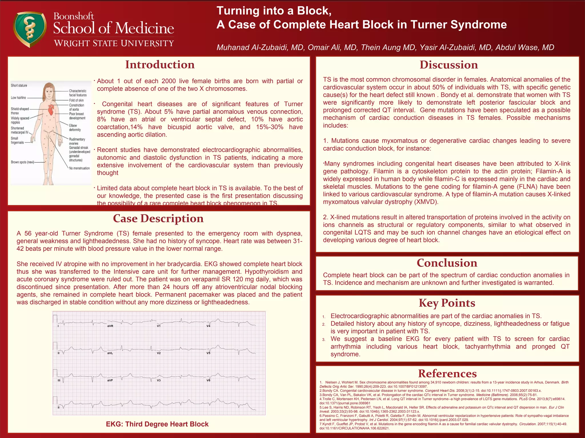 Turning into Block , A Case of Complete Heart Block in Turner Syndrome ...