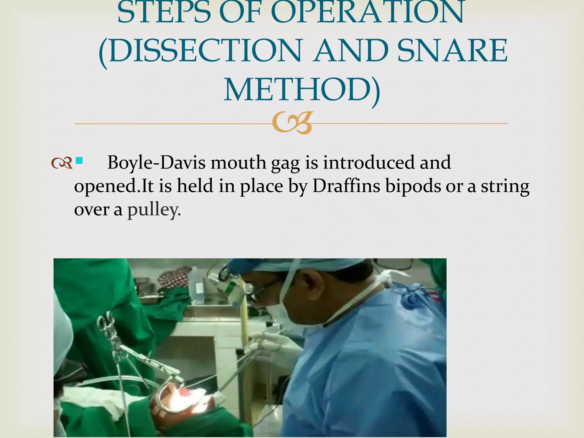 Tonsillectomy | PPTX