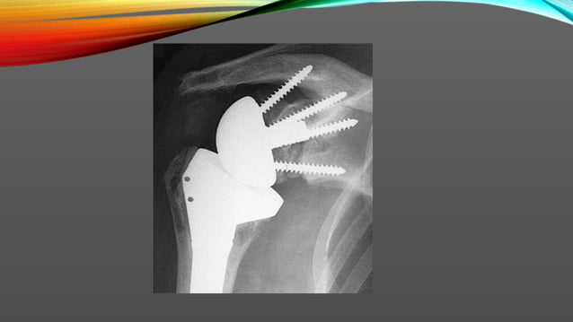 Total shoulder arthroplasty presentation | PPT