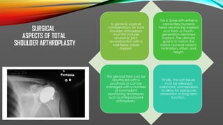 Total shoulder arthroplasty presentation | PPTX
