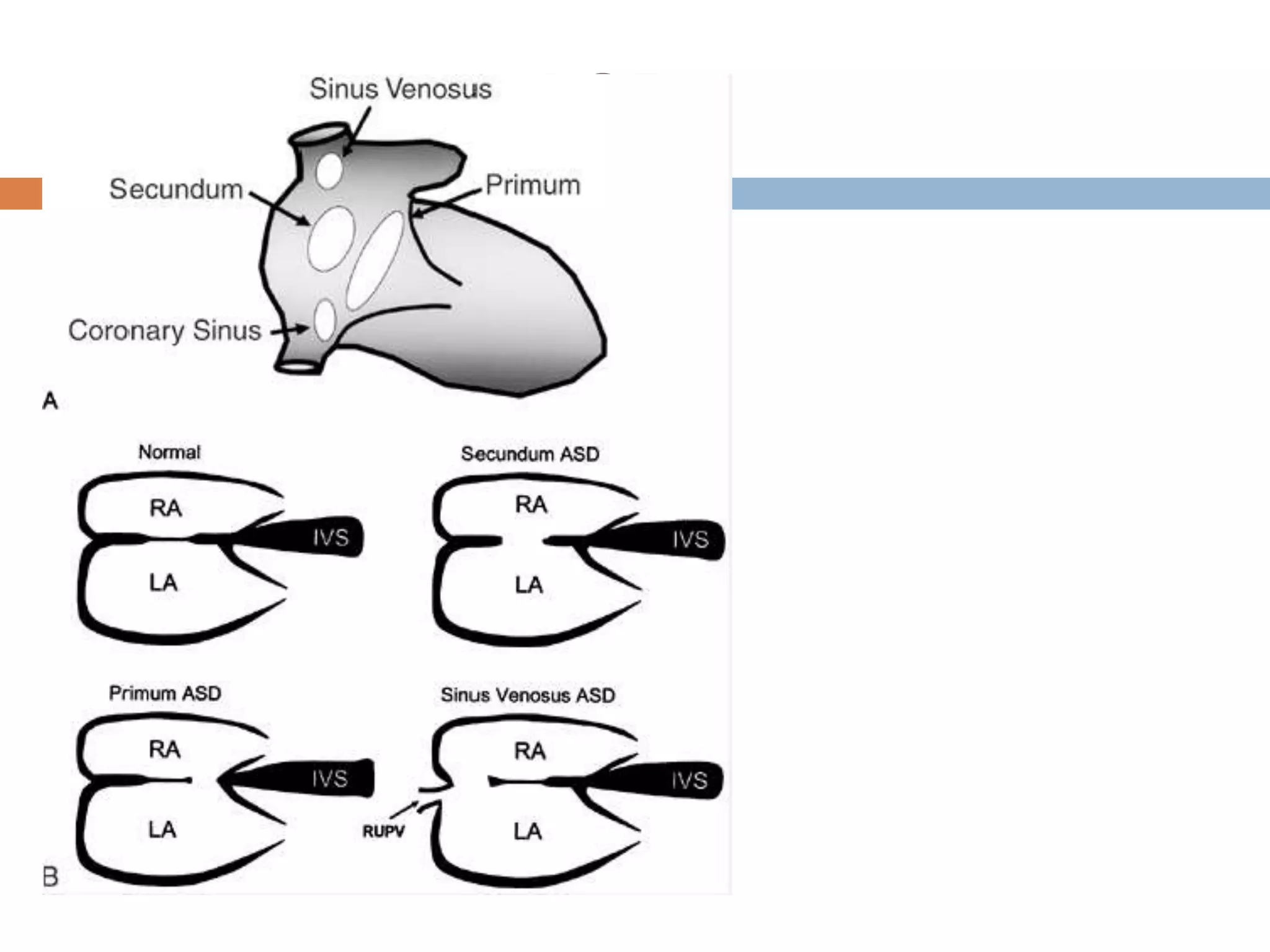 Tte and tee assessment for asd closure 2 | PPTX