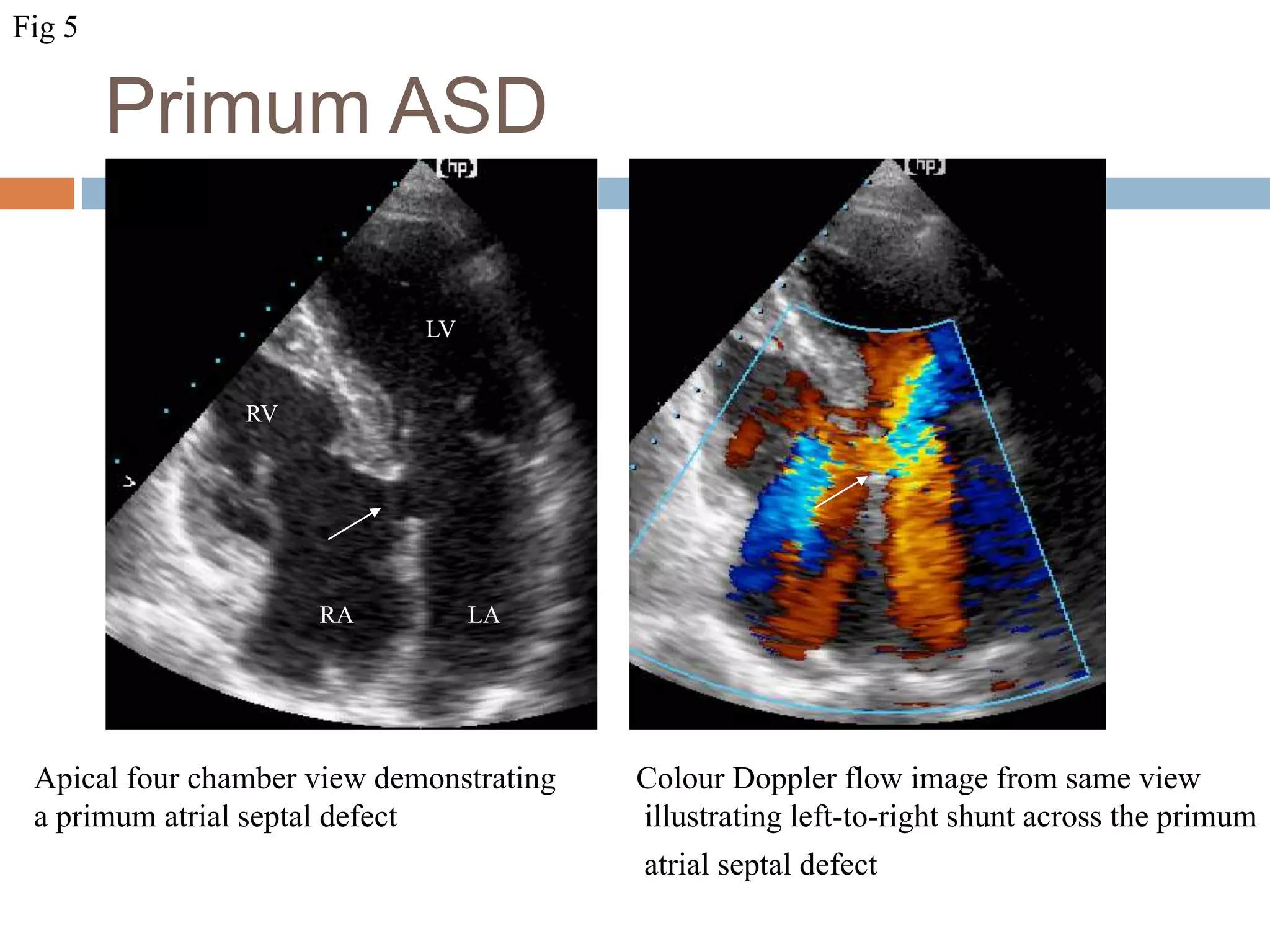 Tte and tee assessment for asd closure 2 | PPTX