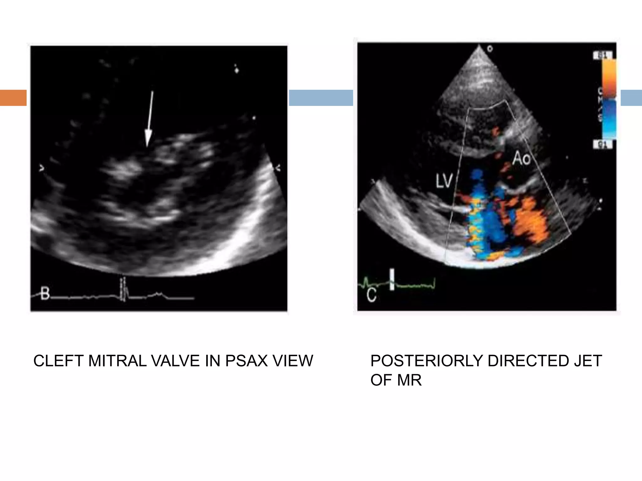 Tte and tee assessment for asd closure 2 | PPTX