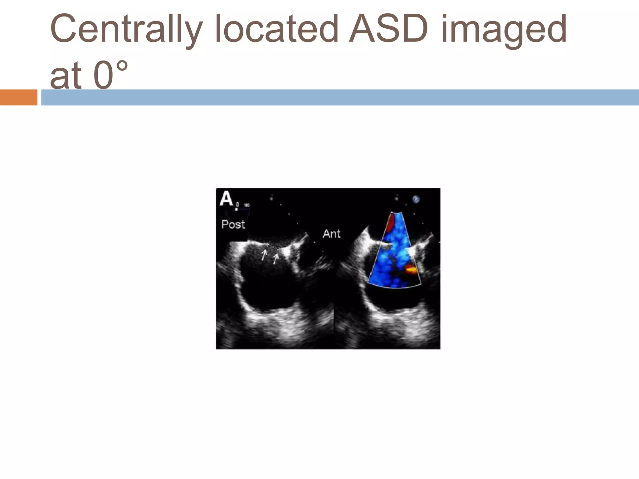 Tte and tee assessment for asd closure 2 | PPTX