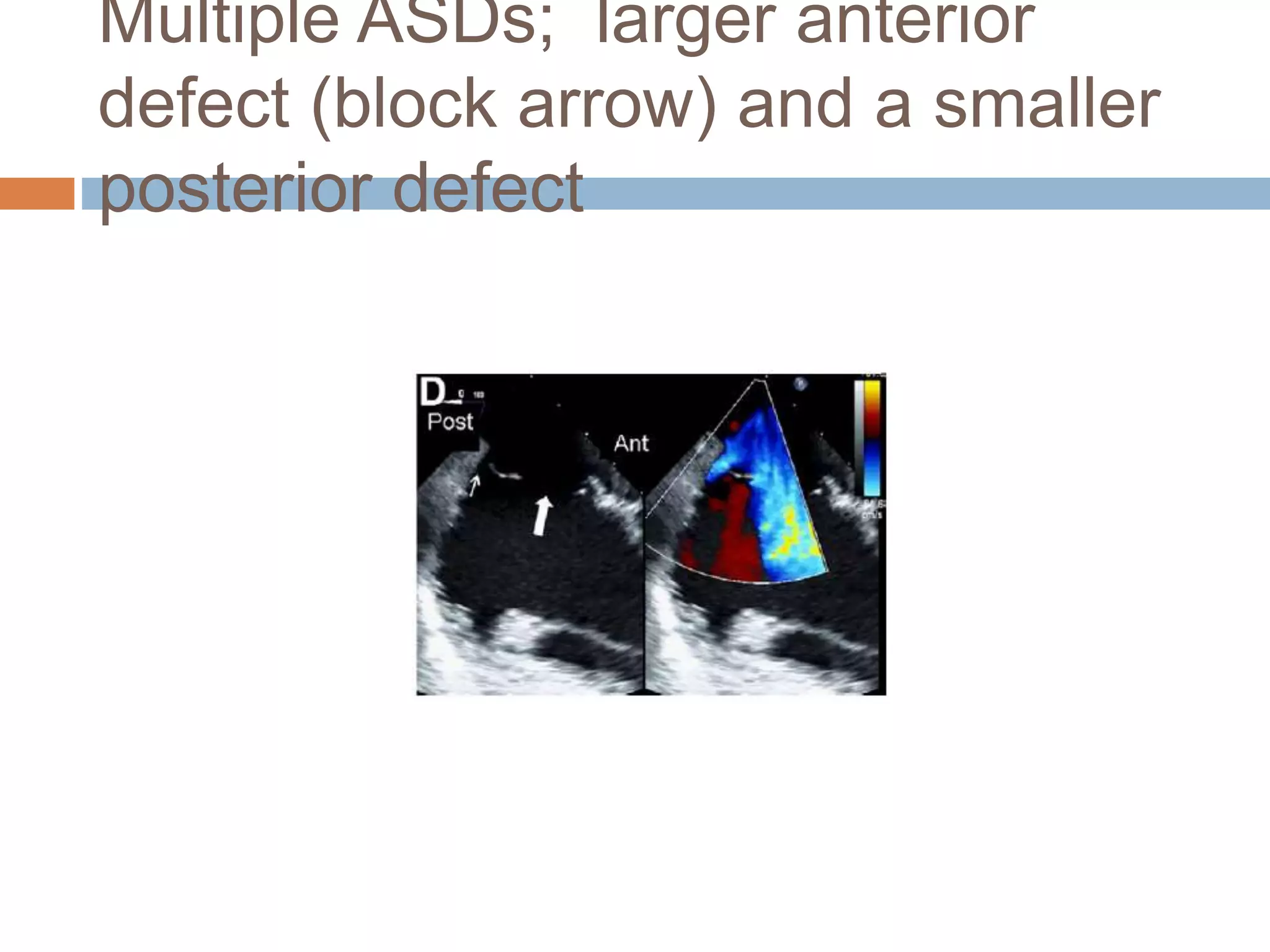 Tte and tee assessment for asd closure 2 | PPTX
