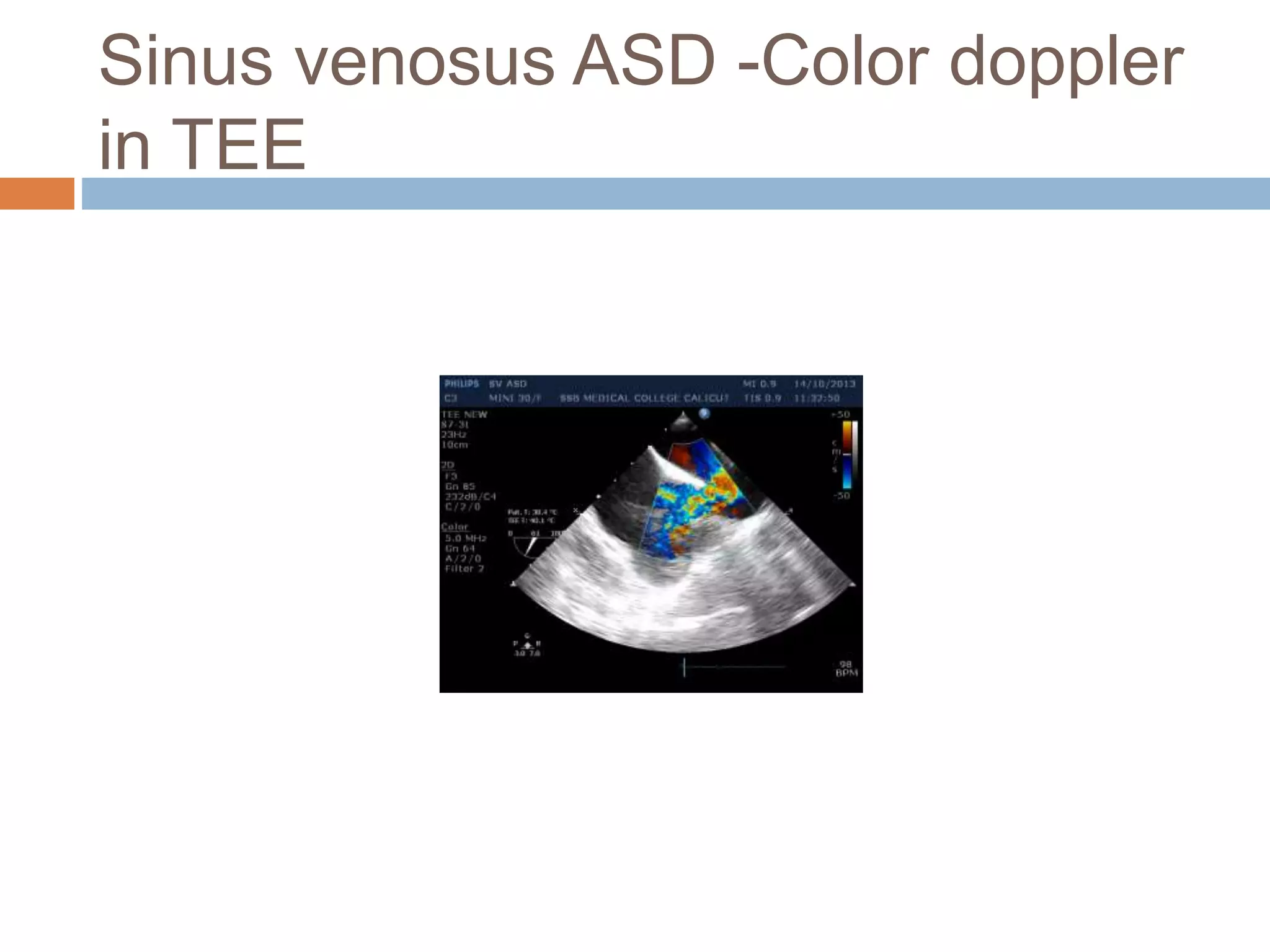 Tte and tee assessment for asd closure 2 | PPTX