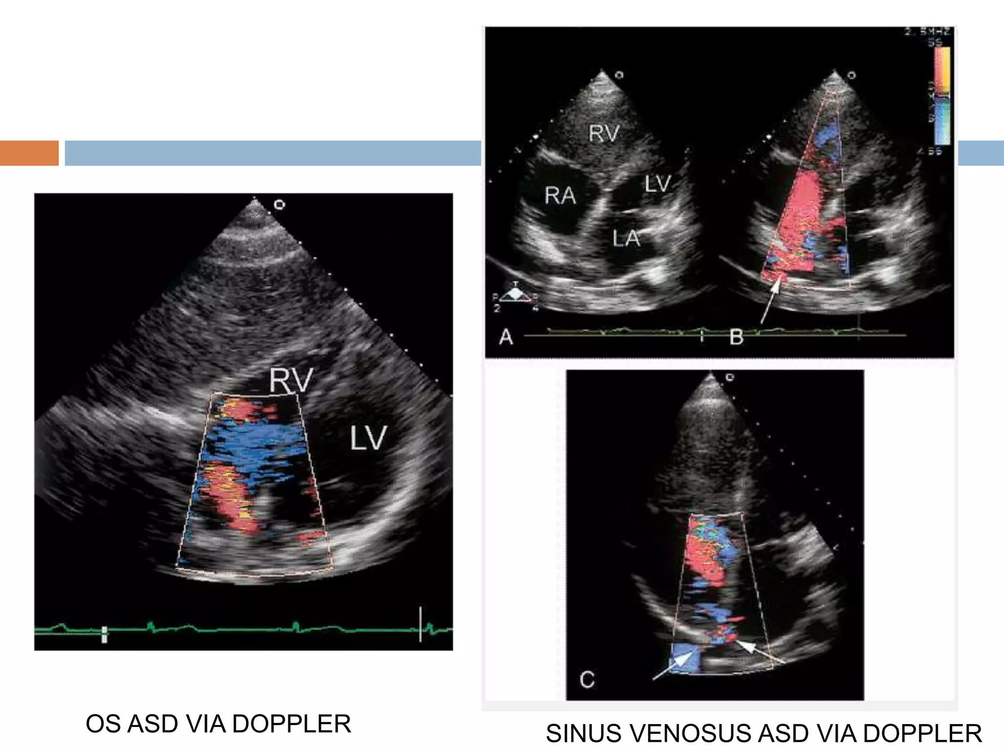 Tte and tee assessment for asd closure 2 | PPTX