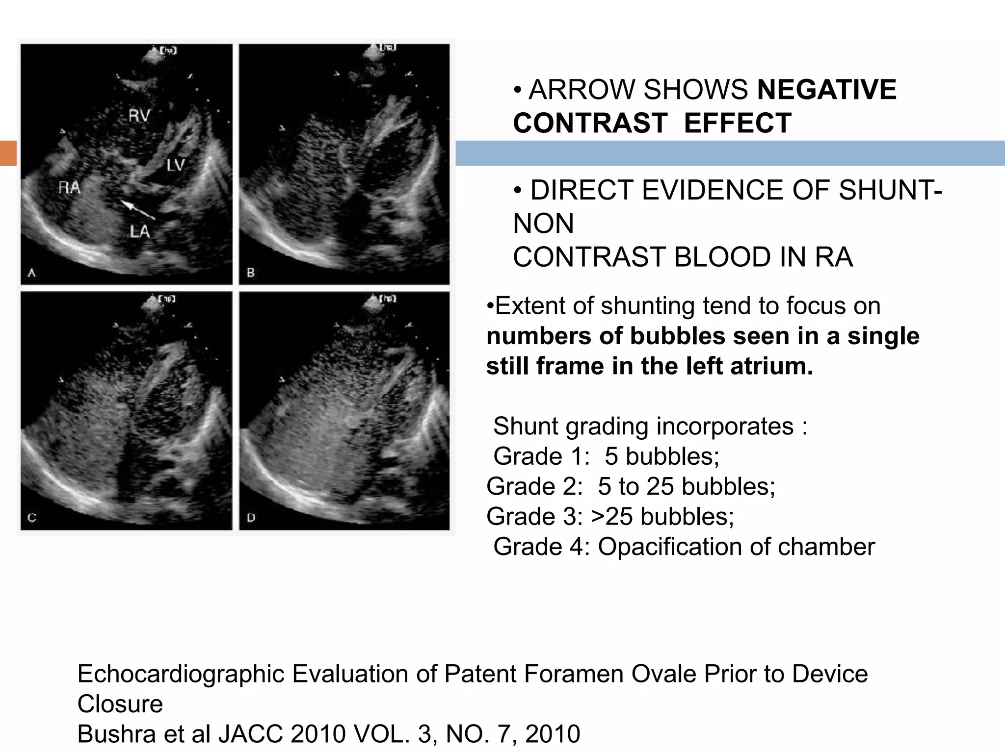 Tte and tee assessment for asd closure 2 | PPTX