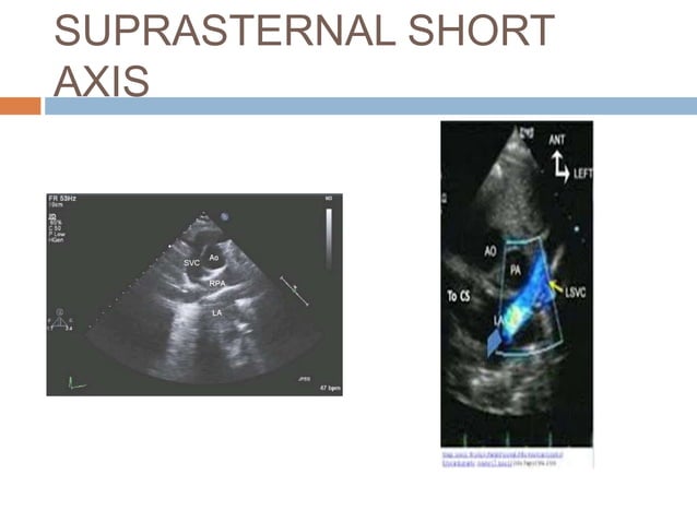 Tte and tee assessment for asd closure 2 | PPTX | Heart and ...