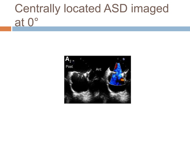 Tte and tee assessment for asd closure 2 | PPTX | Heart and ...