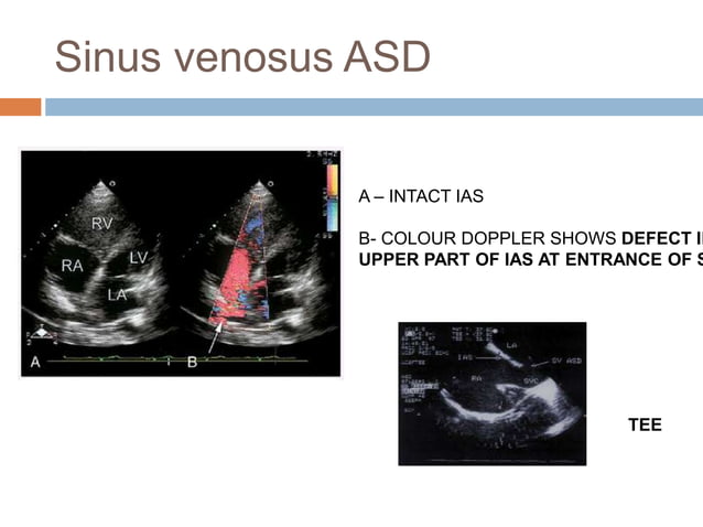 Tte and tee assessment for asd closure 2 | PPT