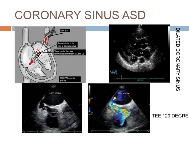 Tte and tee assessment for asd closure 2 | PPT