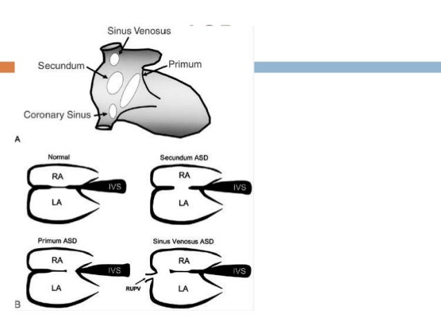 Tte and tee assessment for asd closure 2