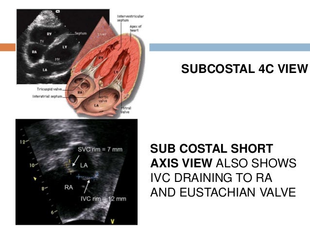 Tte and tee assessment for asd closure 2