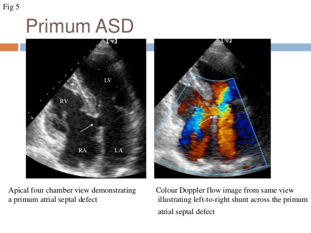 Tte and tee assessment for asd closure 2