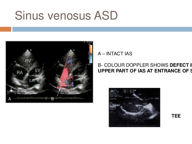 Tte and tee assessment for asd closure 2