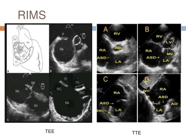 Tte and tee assessment for asd closure 2