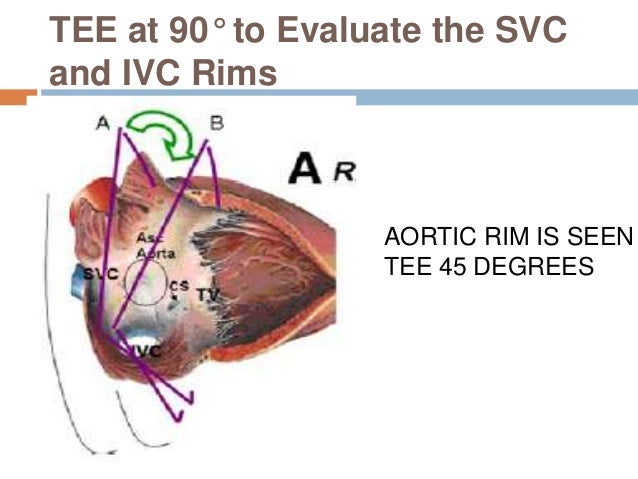 Tte and tee assessment for asd closure 2