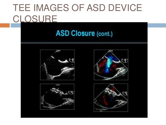Tte and tee assessment for asd closure 2