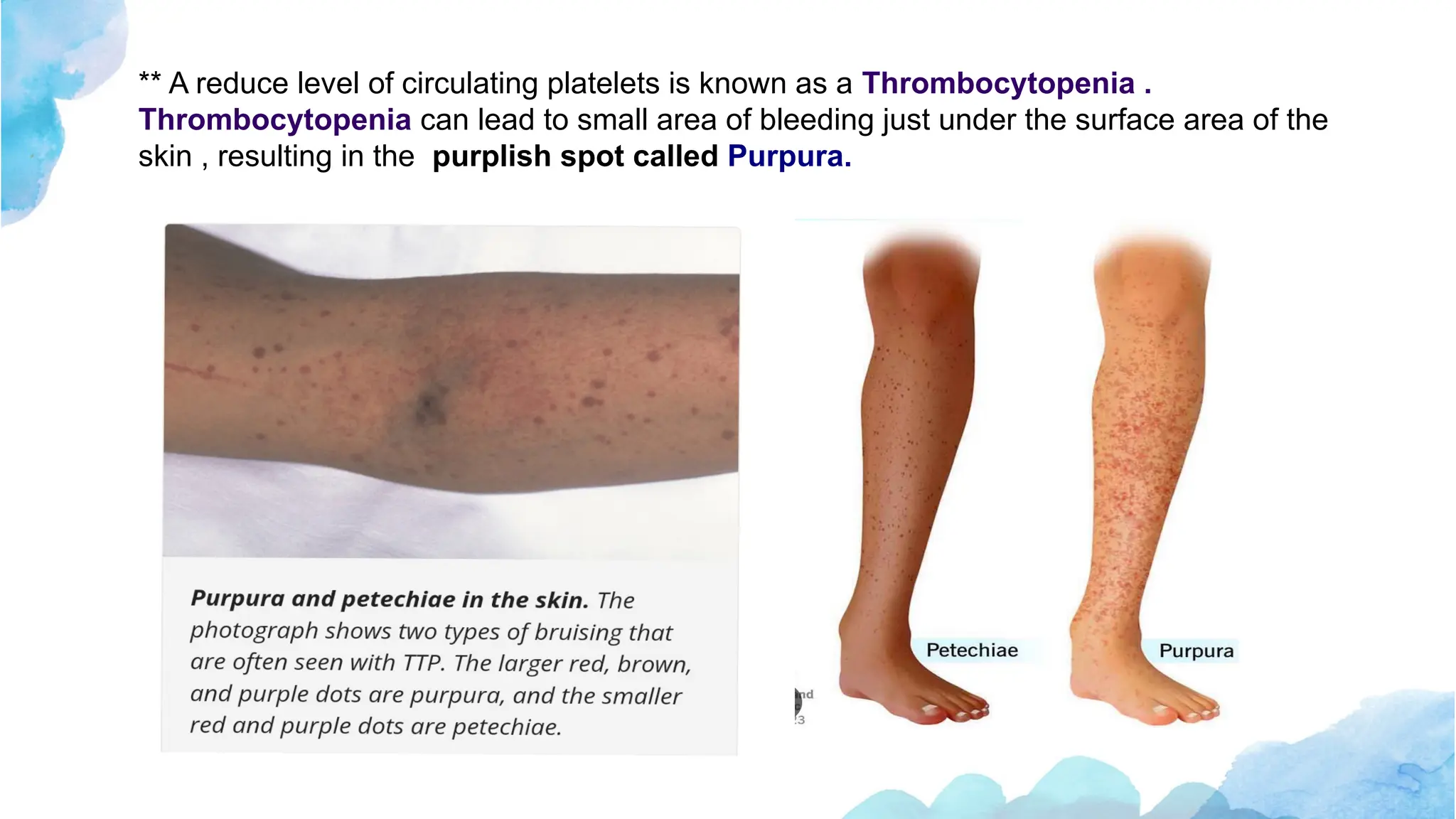Thrombotic thrombocytopenia purpura .pptx