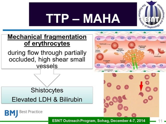 Thrombotic Thrombocytopenic Purpura / Hemolytic Uremic Syndrome (Questions & Answers) - Dr ...