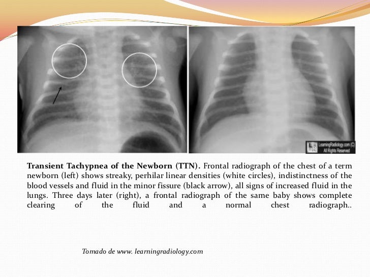 Taquipnea Transitoria del Recién Nacido