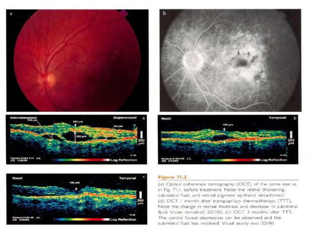 Transpupillary Thermotherapy (TTT) | PPTX | Eye and Vision Conditions ...