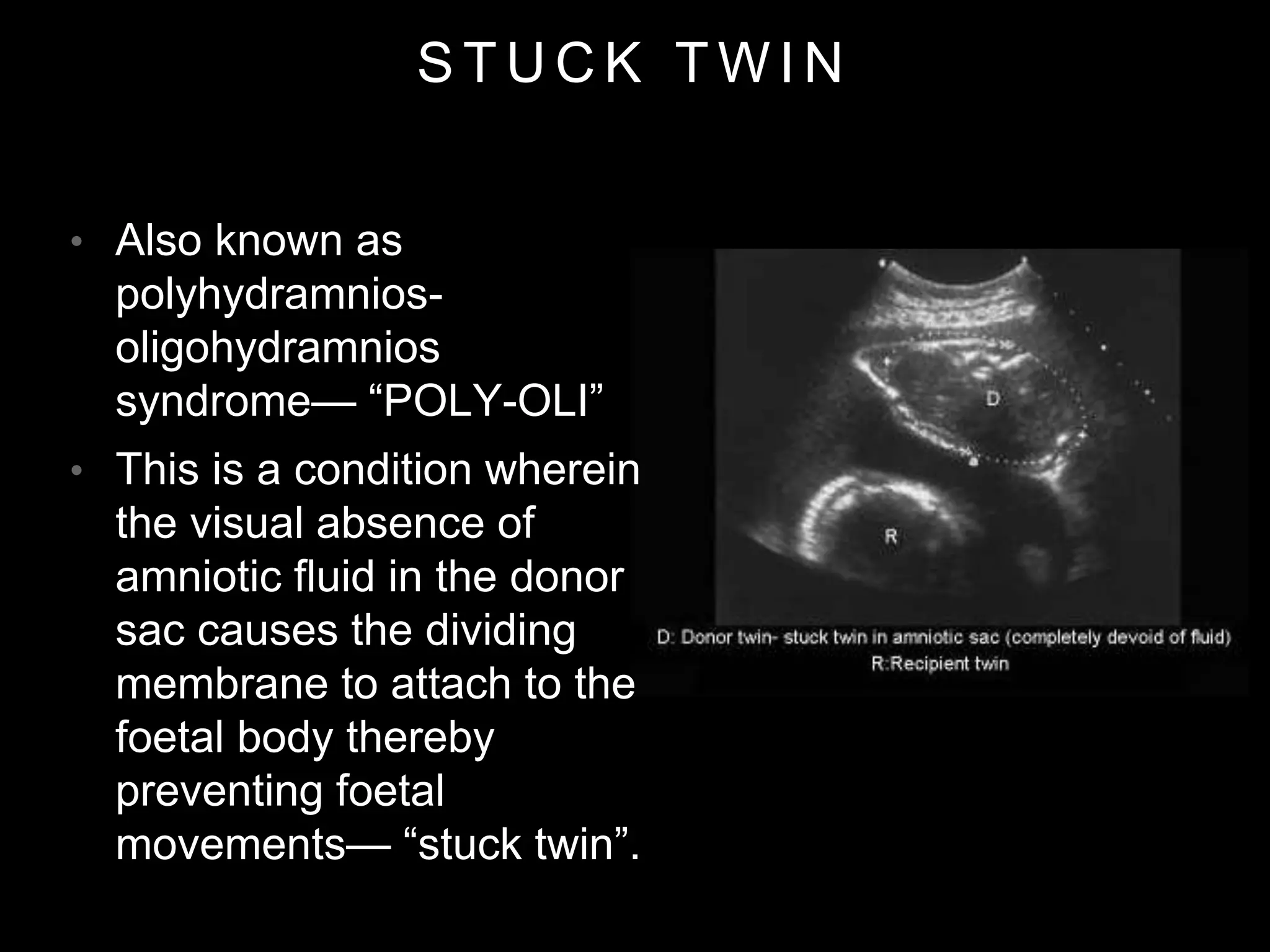 Twin to twin transfusion syndrome | PPTX