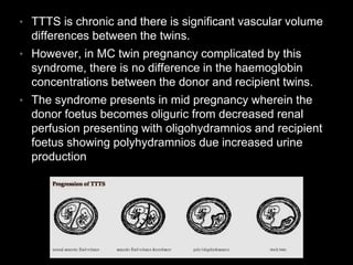 Twin to twin transfusion syndrome | PPTX