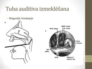 Tuba auditiva disfunkcija | PPTX