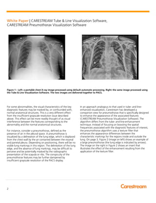 Tube and Line and Pneumothorax Visualization Software | PDF