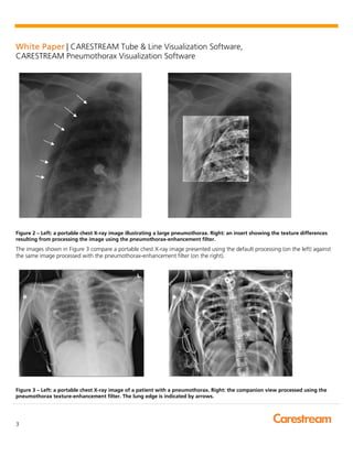 Tube and Line and Pneumothorax Visualization Software | PDF