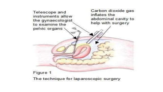 Tubectomy, Non Scalpel Vasectomy ( sterilization) | PPT